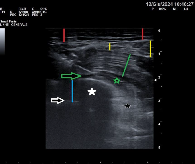 Efficacy and safety of the serratus anterior plane block (SAP block ...