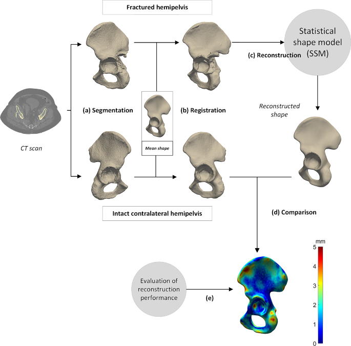 Automatic virtual reconstruction of acetabular fractures using a ...