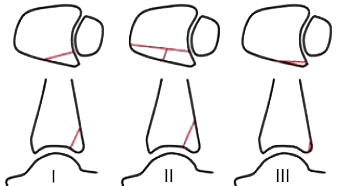 Type B ankle fractures with additional medium-sized posterior fragment ...
