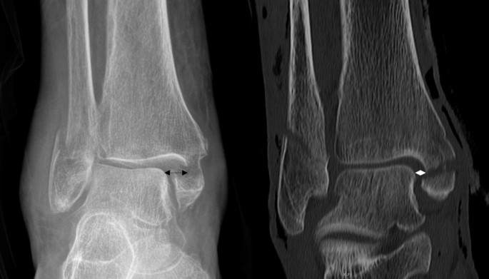 The medial clearspace is a risk factor for secondary dislocation ...