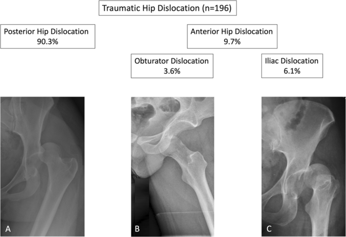 Risk factors and long-term outcomes in anterior iliac and obturator hip ...