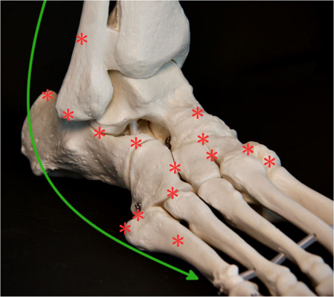 Outcome of avulsion fractures in the foot after supination trauma: A ...