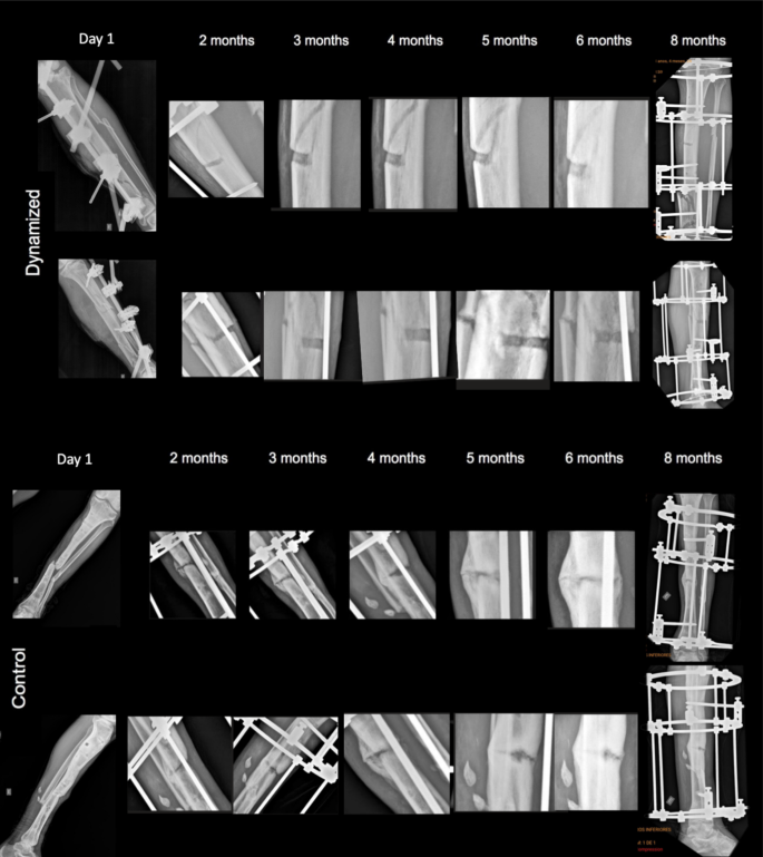 Novel device for controlled dynamization of tibial fractures ...