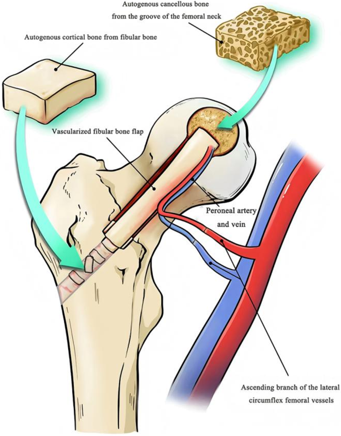 Free vascularized fibular grafting for osteonecrosis of the femoral ...