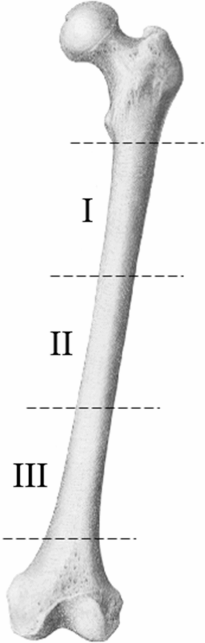 Long-term outcome after middle third fractures of the femur shaft; a ...