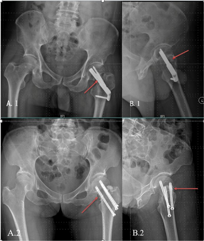 Complications and risk factors after internal fixation of femoral neck ...