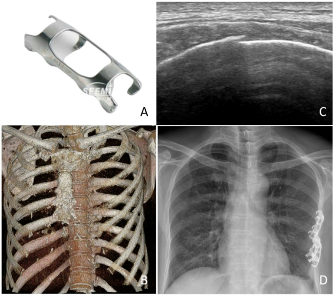Comparative study of total thoracoscopic and traditional incision ...
