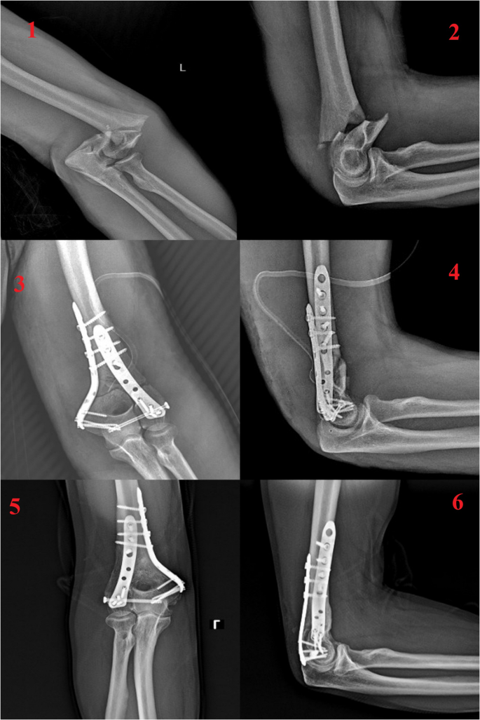 Factors associated with heterotopic ossification following surgical ...