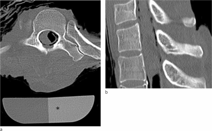 Trabecular and cortical bone mineral density in human vertebrae ...