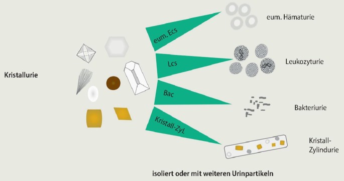 Kristalle im Urin bei Urolithiasis | Uro-News