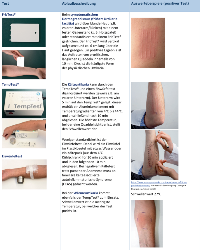 Physikalische Testungen bei Urtikaria | Die Dermatologie