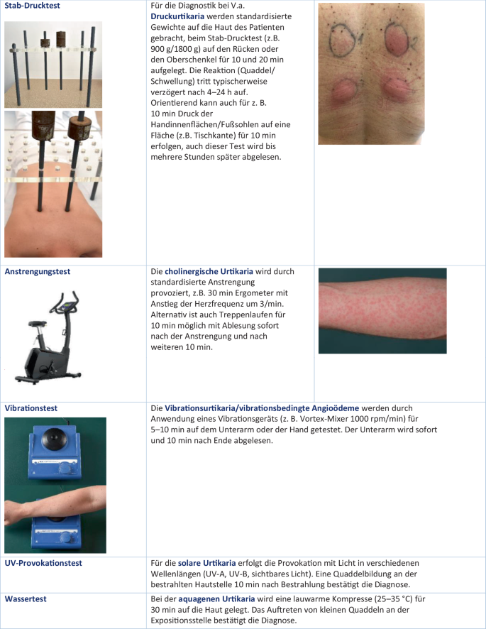 Physikalische Testungen bei Urtikaria | Die Dermatologie