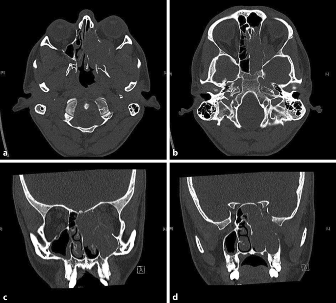 Einseitige Nasenatmungsbehinderung mit Epistaxis | HNO