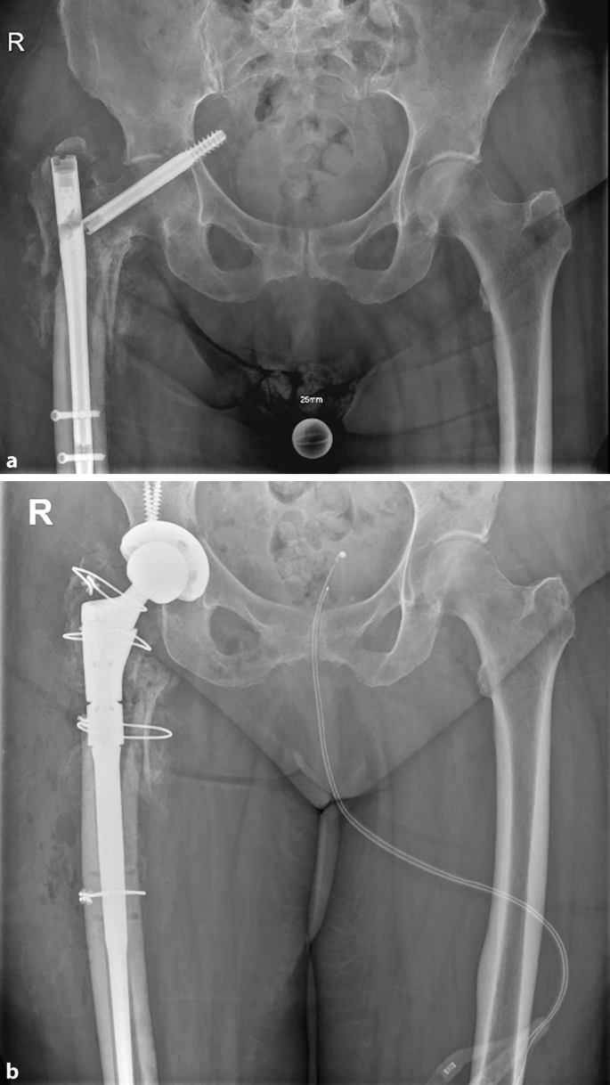 Pertrochantäre Frakturen | Die Unfallchirurgie