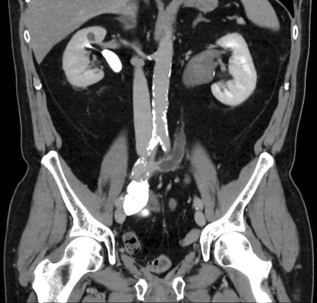 Endosonographische Punktion zur Diagnostik eines ...