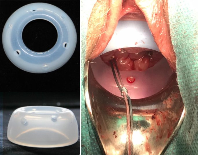 Therapie bei kurzer Zervix – Pessar, Cerclage oder totaler ...