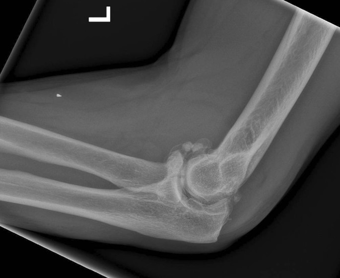 Kubitalarthrose | Die Orthopädie