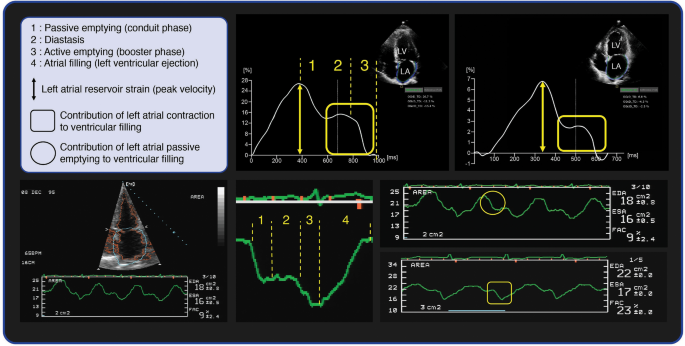 Left atrial reservoir strain: an essential tool for evaluating left ...
