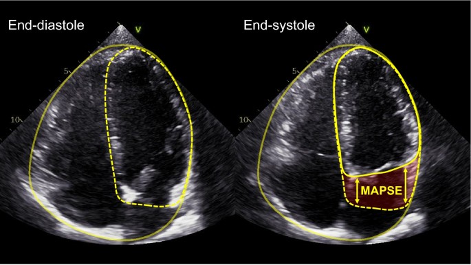 Monitoring left ventricular function with MAPSE and critical care ...