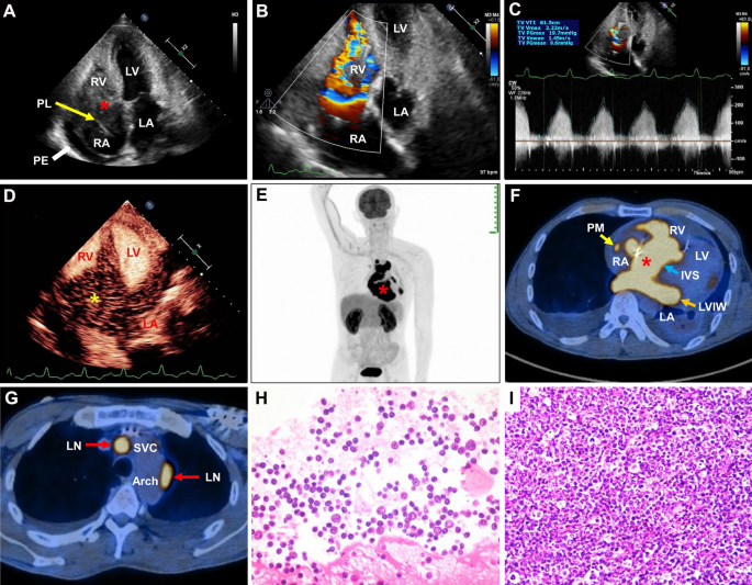 Primary cardiac lymphoma initially suspected as device-associated ...