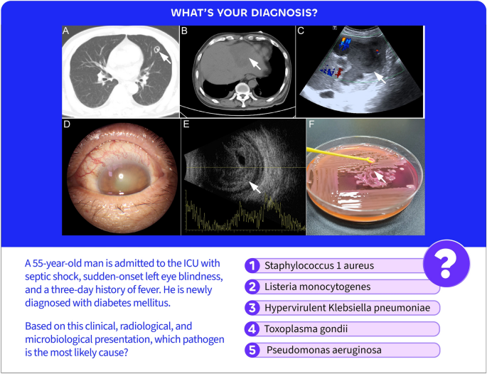Hypervirulent Klebsiella pneumoniae: watch the eyes | Intensive Care ...