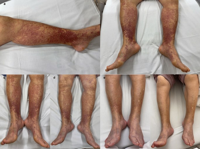 Serum sickness: a mimic of septic shock | Intensive Care Medicine