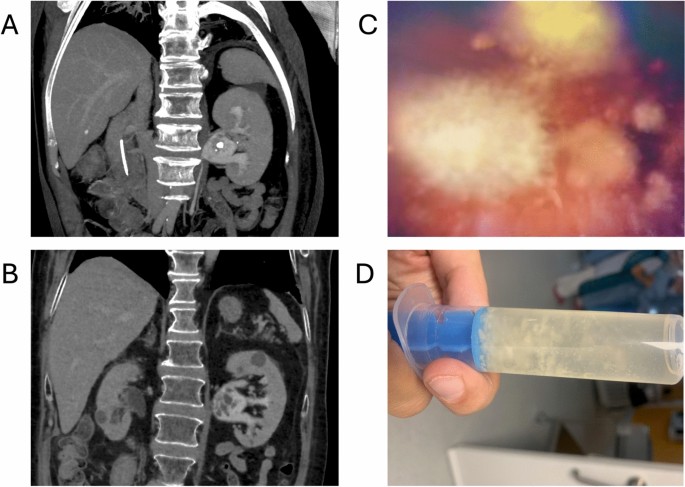 Urinary tract fungus balls in an immunocompromised patient with ...