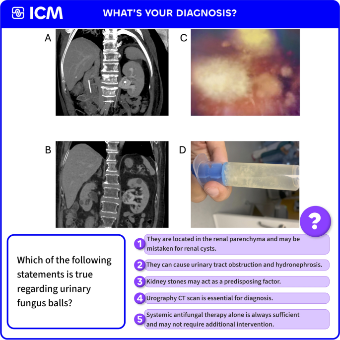 Urinary tract fungus balls in an immunocompromised patient with ...