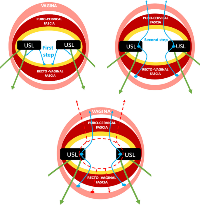 A Modified McCall Culdoplasty in Pelvic Organ Prolapse Surgery ...