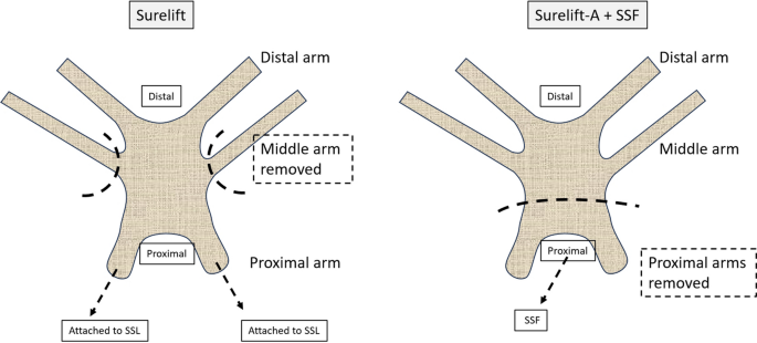 Comparison Between Anterior-Apical Mesh (Surelift) and Anterior Mesh ...