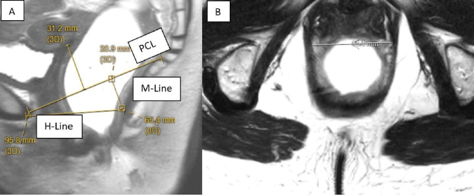 Assessing Pelvic Organ Prolapse Volume in Patients with Rectal Prolapse ...