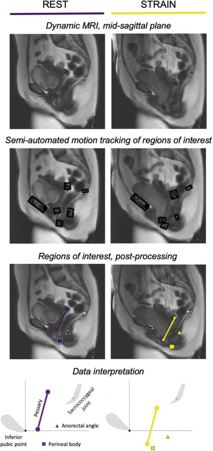 Automated Motion Tracking of Vaginal Pessaries and Pelvic Floor ...