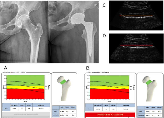 Bone mineral density assessment using radiofrequency echographic ...