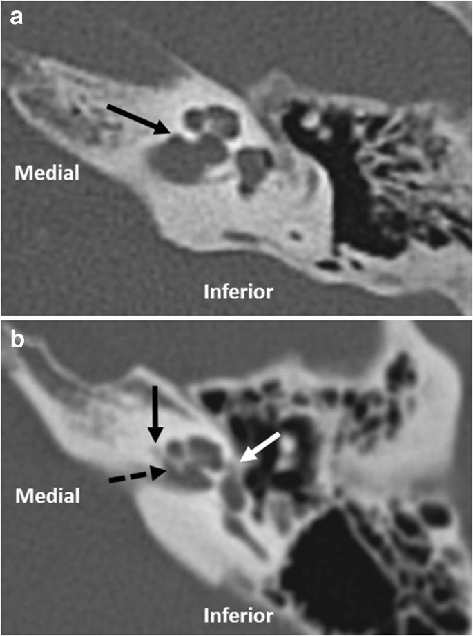 Internal Auditory Canal