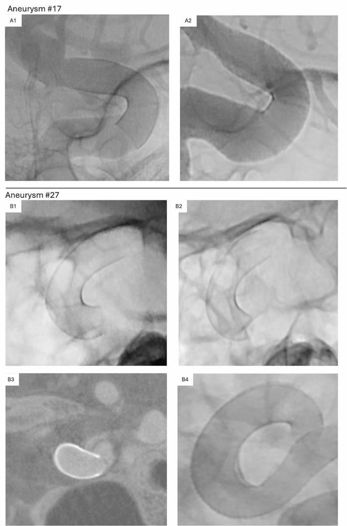 Preliminary results of intracranial aneurysm treatment with derivo2heal ...