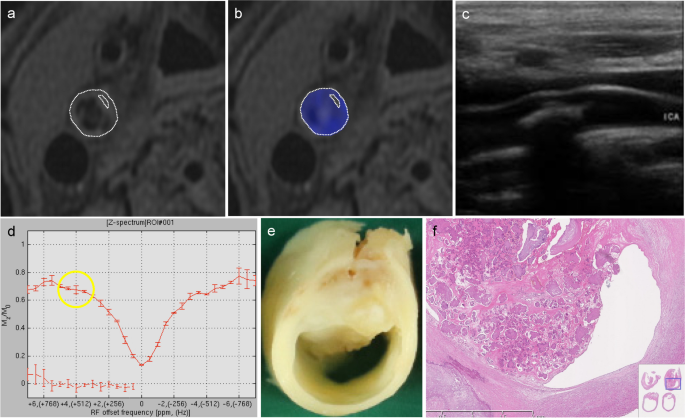 Characterization of carotid plaques using chemical exchange saturation ...