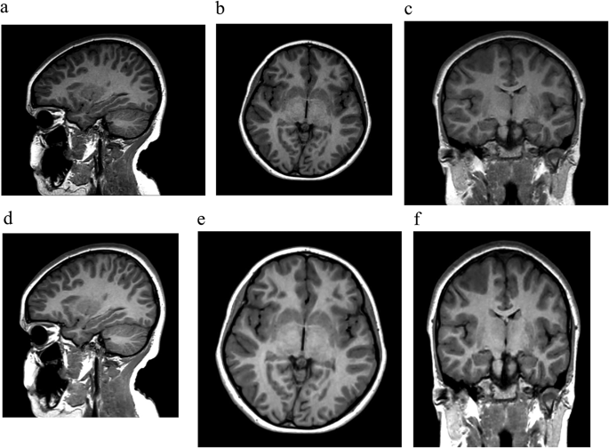 Evaluation of 3D T1-weighted spoiled gradient echo MR image quality using artificial ...