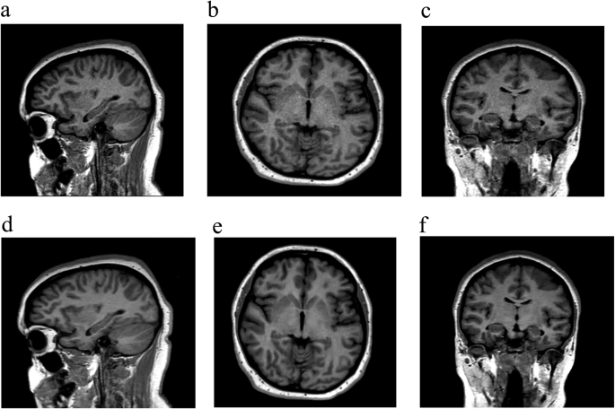 Evaluation of 3D T1-weighted spoiled gradient echo MR image quality ...