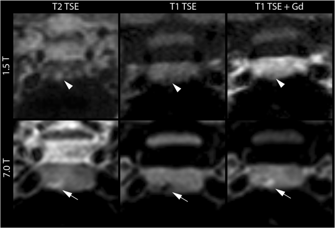 Review of 7T MRI imaging of pituitary microadenomas: are we there yet ...