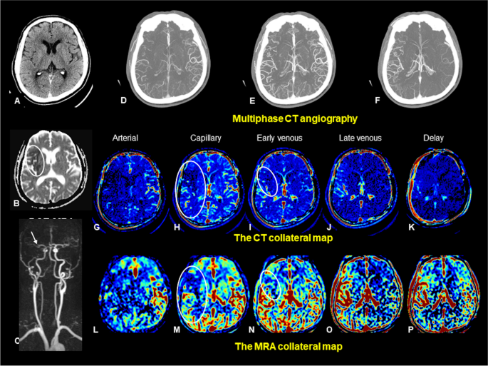Multiphase CTA vs. MRA collateral map for predicting functional ...