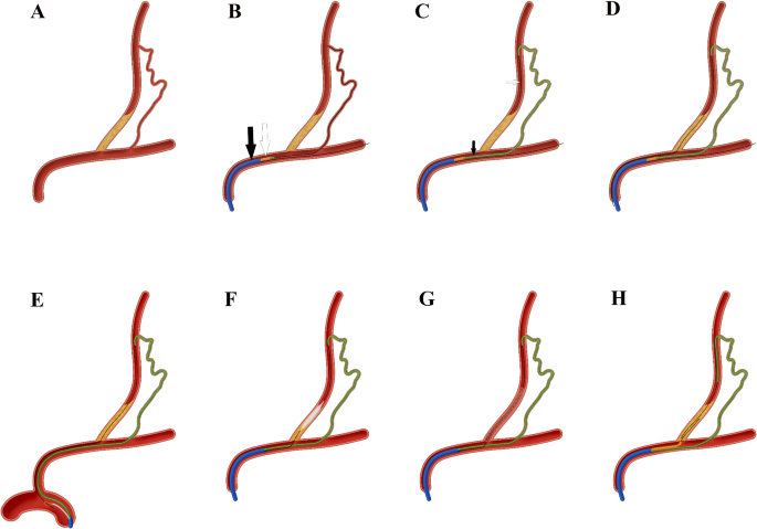 Retrograde recanalization for vertebral artery occlusion without a ...