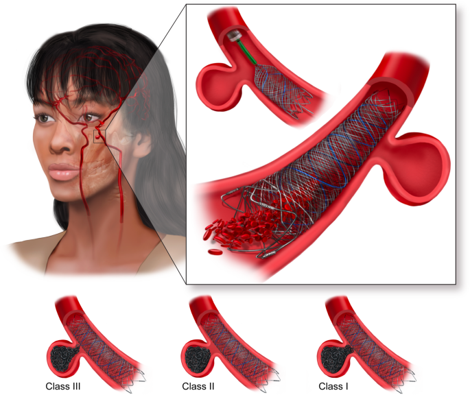 FRED X flow diversion stent for intracranial aneurysms: a systematic ...