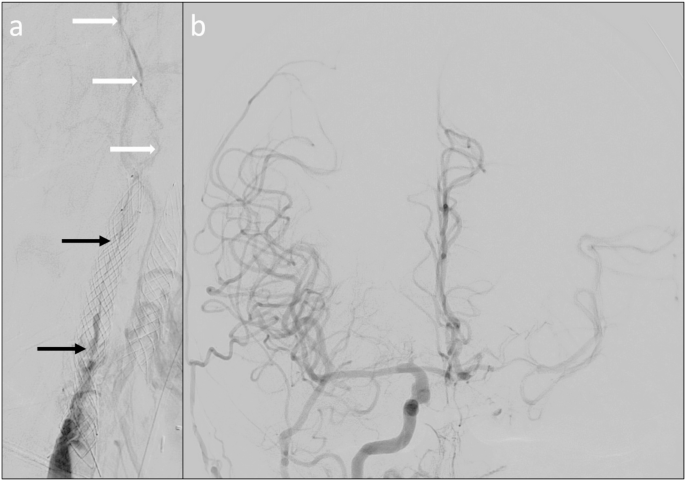 Recanalization of a chronic long segment ICA near-occlusion using a ...