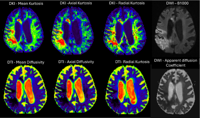 Diffusion kurtosis imaging in acute ischemic stroke: A systematic ...