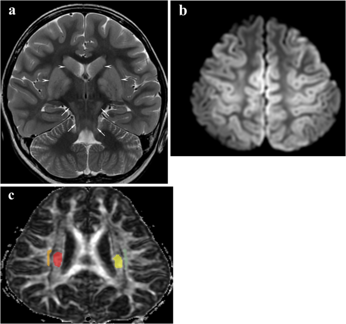 Disrupted age-related glymphatic patterns in children with deep gray ...