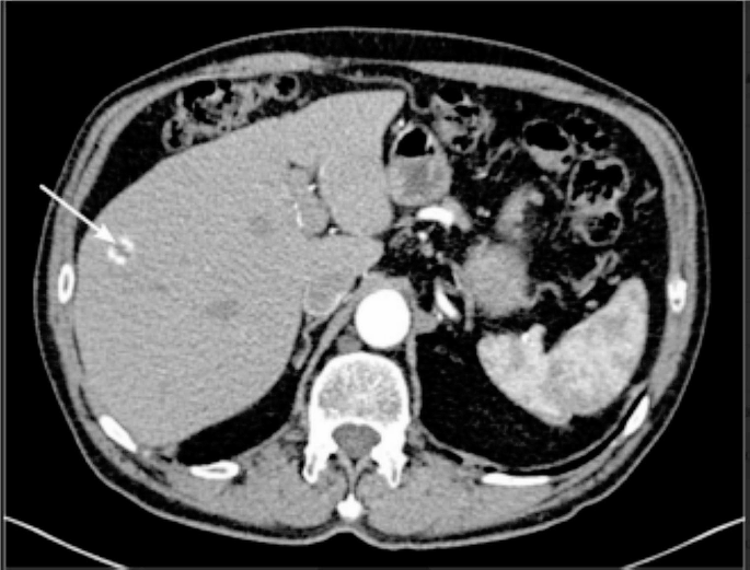 Incidental findings in 1000 consecutive CT angiograms for DIEP flap ...
