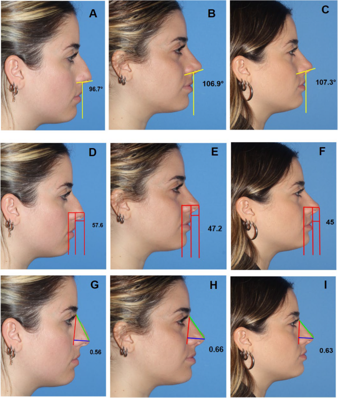ANSA banner graft in rhinoplasty: Long-term results in projection and ...