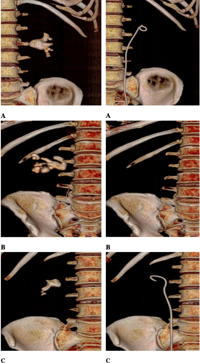 Successful treatment of staghorn stones with flexible ureteroscopy and ...