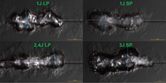 Characterizing stone ablation with the thulium fiber laser: a single ...