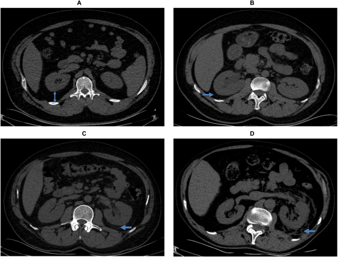 Impact of the Mayo adhesive probability score on ESWL outcomes for ...